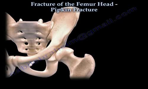 Fractures Of The Femur Head ,Pipkin Fracture Everything You Need To ...